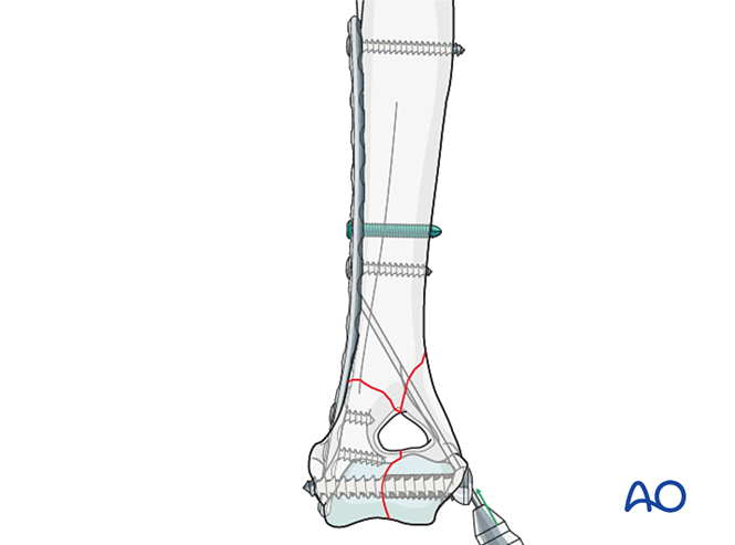 Transcondylar screw with unilateral plating and contralateral ...