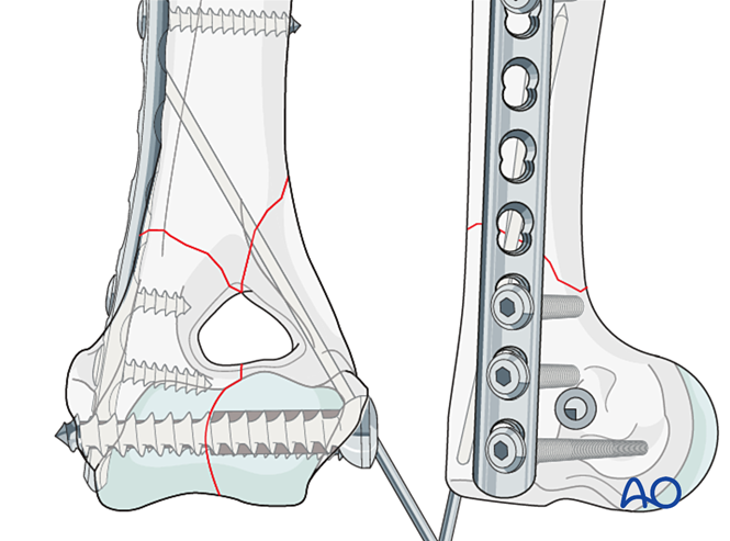 Transcondylar screw with unilateral plating and contralateral ...