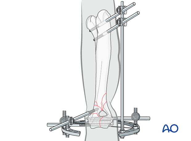 Transcondylar screw and hybrid circular external skeletal fixator for ...