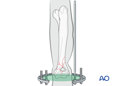 Transcondylar screw and hybrid circular external skeletal fixator for ...