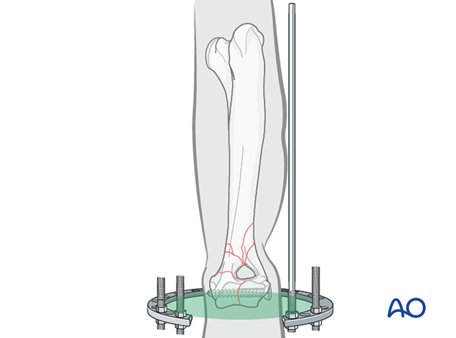Transcondylar screw and hybrid circular external skeletal fixator for ...