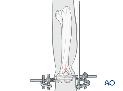 Transcondylar screw and hybrid circular external skeletal fixator for ...