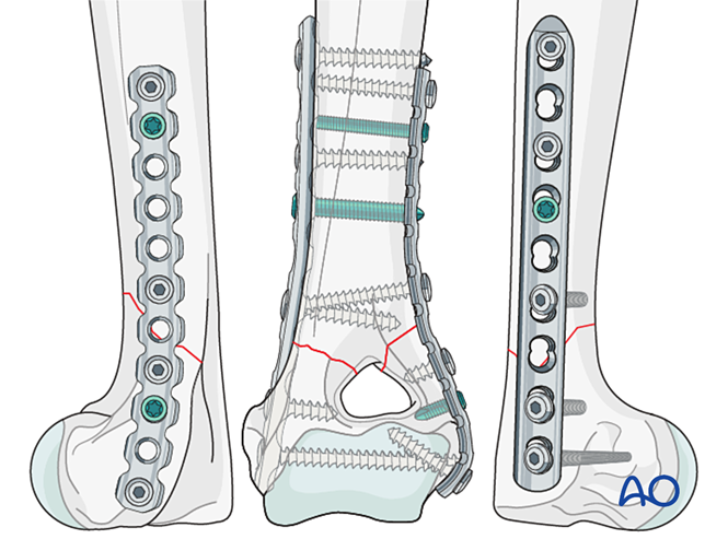 Double compression or neutralization plating for Simple extra-articular ...