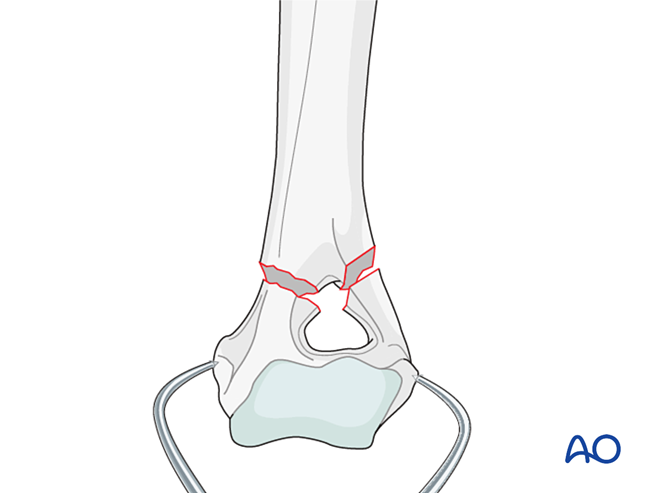 Cross pinning for Simple extra-articular fracture of the dog distal humerus