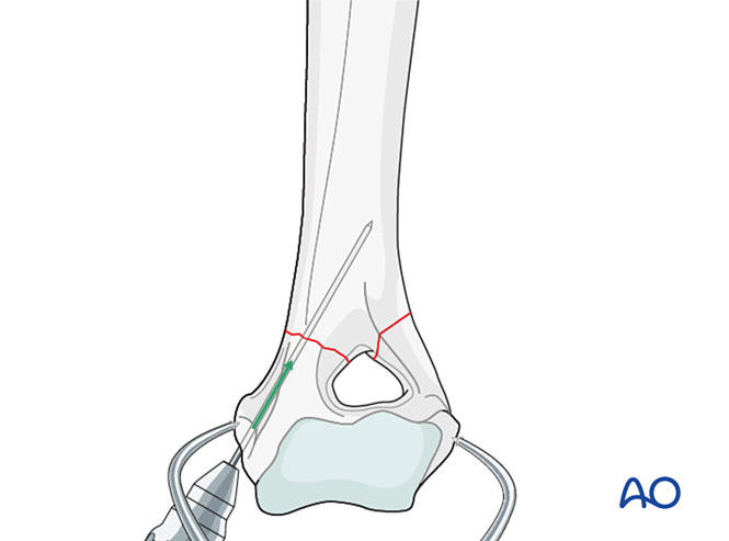 Neutralization or compression plate and pin for Extra-articular simple ...