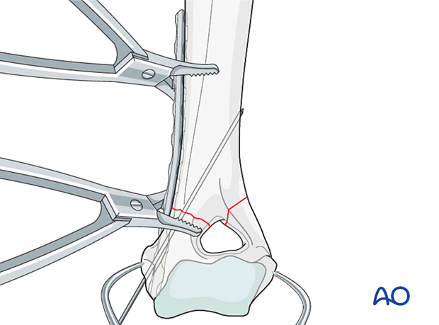 Double compression or neutralization plating for Simple extra-articular ...
