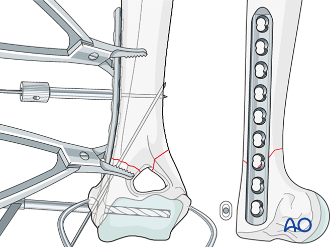 Double compression or neutralization plating for Simple extra-articular ...