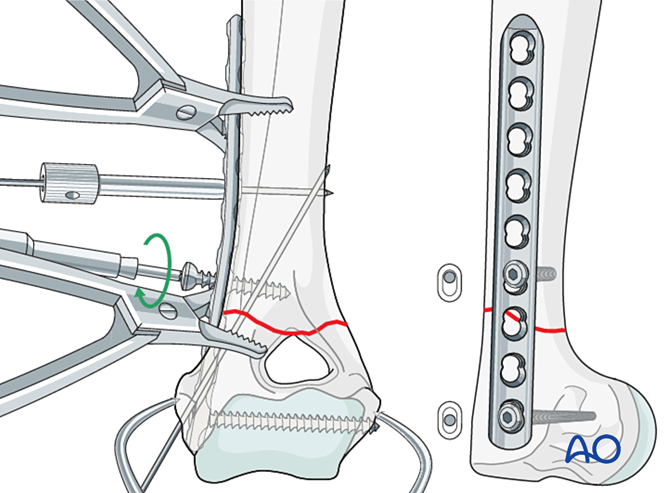 Double compression or neutralization plating for Simple extra-articular ...