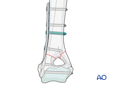 Double compression or neutralization plating for Simple extra-articular ...