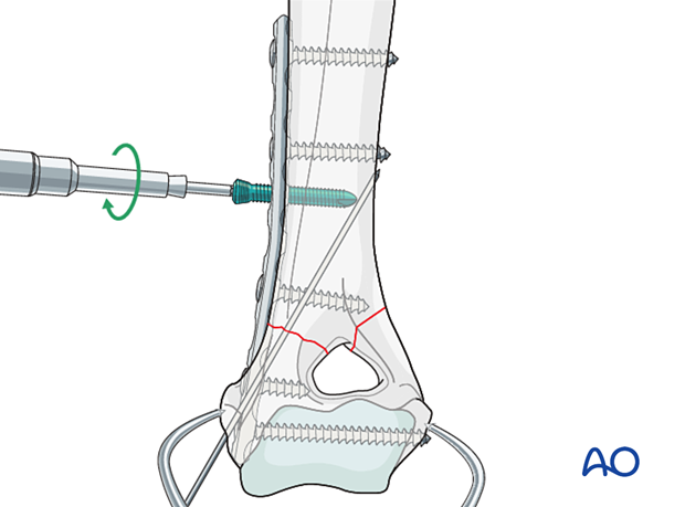 Double compression or neutralization plating for Simple extra-articular ...