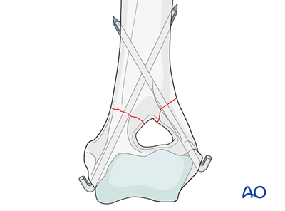Cross pinning for Simple extra-articular fracture of the dog distal humerus