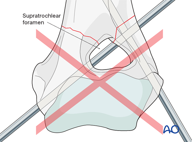Cross pinning for Simple extra-articular fracture of the dog distal humerus