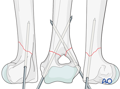 Cross pinning for Simple extra-articular fracture of the dog distal humerus
