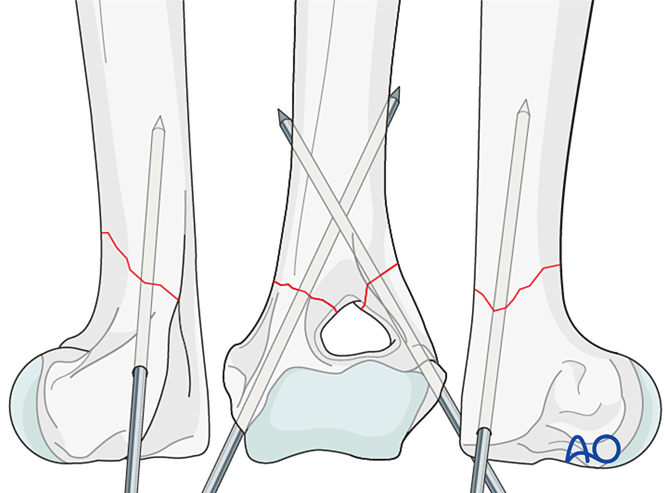 Cross pinning for Simple extra-articular fracture of the dog distal humerus