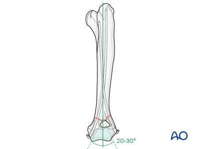 Cross pinning for Simple extra-articular fracture of the dog distal humerus