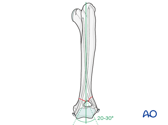 Cross pinning for Simple extra-articular fracture of the dog distal humerus