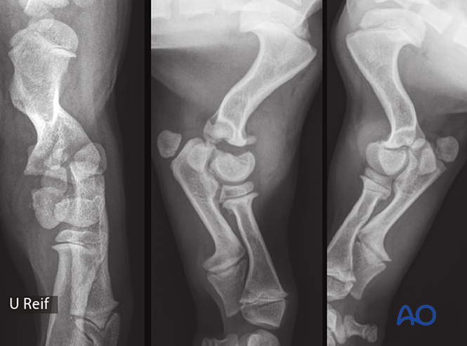 Cross pinning for Simple extra-articular fracture of the dog distal humerus