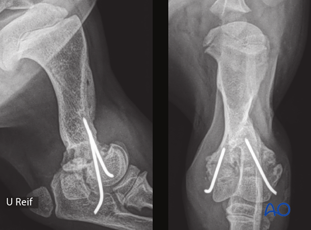 Cross pinning for Simple extra-articular fracture of the dog distal humerus