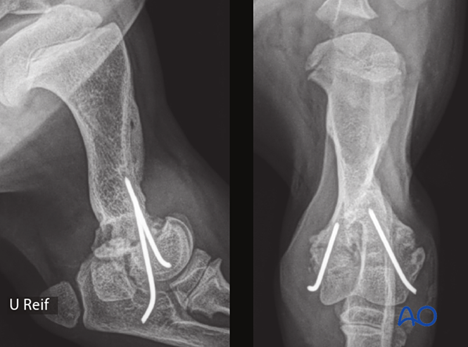 Cross pinning for Simple extra-articular fracture of the dog distal humerus