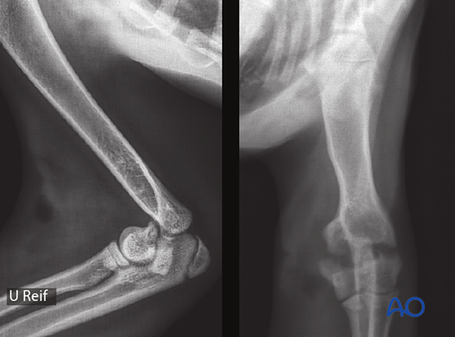 Cross pinning for Simple extra-articular fractures of the distal humerus