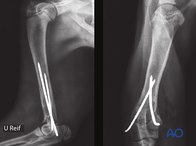 Cross pinning for Simple extra-articular fractures of the distal humerus