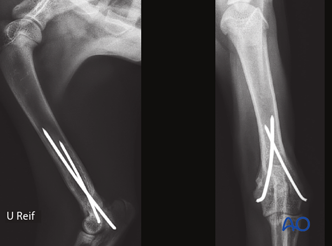 Cross pinning for Simple extra-articular fractures of the distal humerus