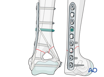 Neutralization or compression plate and pin for Extra-articular simple ...