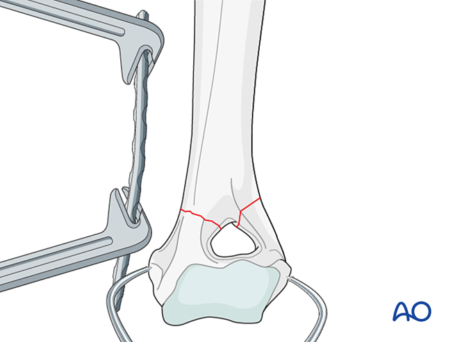 Neutralization or compression plate and pin for Extra-articular simple ...
