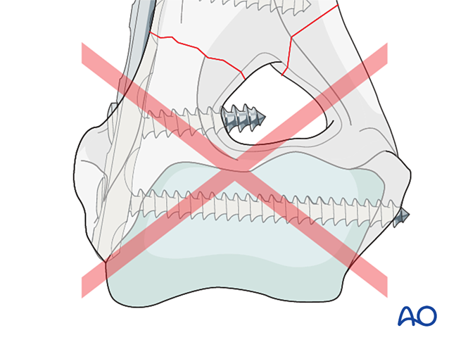 Neutralization or compression plate and pin for Extra-articular simple ...
