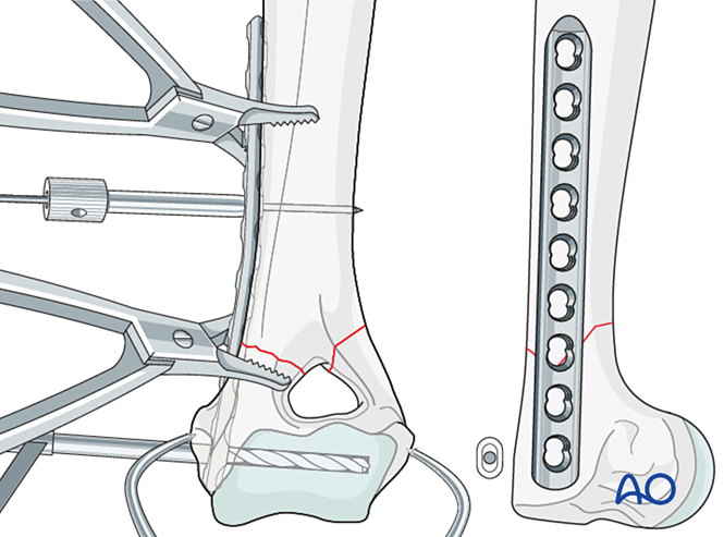 Neutralization or compression plate and pin for Extra-articular simple ...