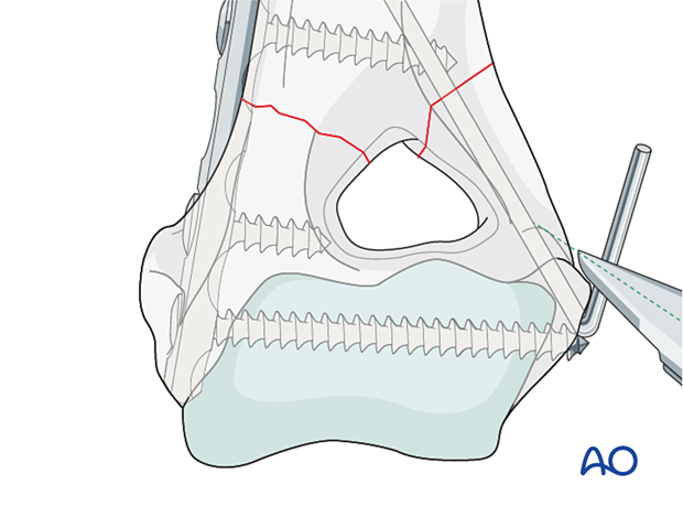 Neutralization or compression plate and pin for Extra-articular simple ...