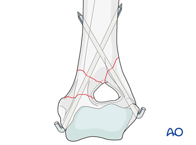 Cross pinning for Extra-articular wedge fractures of the distal humerus
