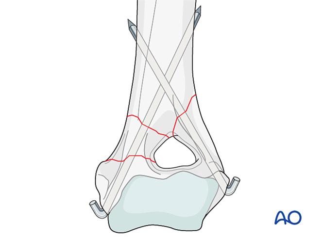 Cross pinning for Extra-articular wedge fractures of the distal humerus