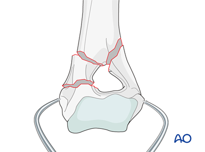 Cross pinning for Extra-articular wedge fractures of the distal humerus
