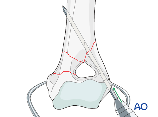 Cross pinning for Extra-articular wedge fractures of the distal humerus