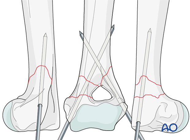Cross pinning for Extra-articular wedge fractures of the distal humerus