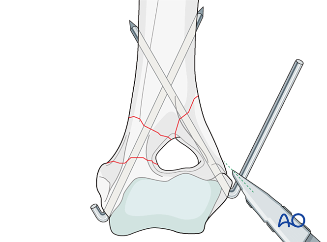 Cross pinning for Extra-articular wedge fractures of the distal humerus