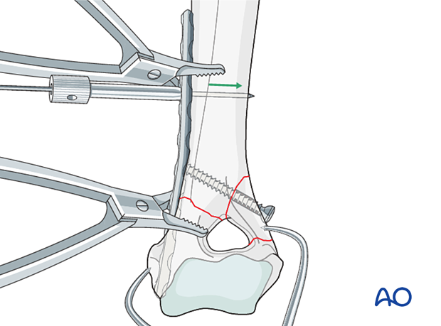 Lag screws and neutralization plate for Extra-articular wedge fractures ...