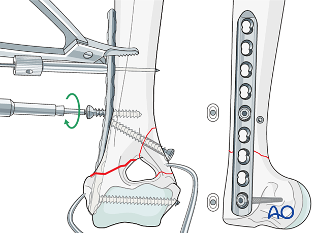 Lag screws and neutralization plate for Extra-articular wedge fractures ...