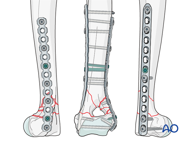 Double buttress plating for Complex extra-articular fractures of the ...