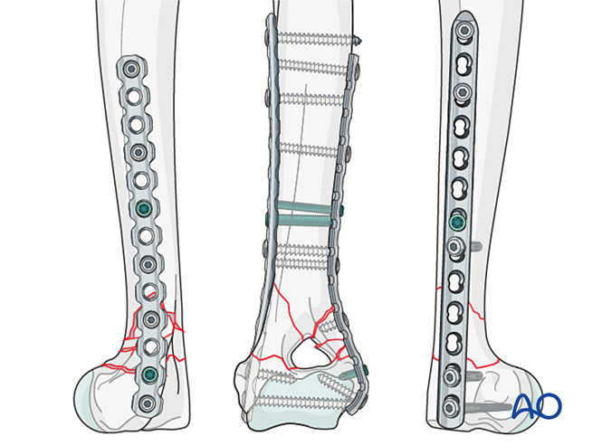Double buttress plating for Complex extra-articular fractures of the ...