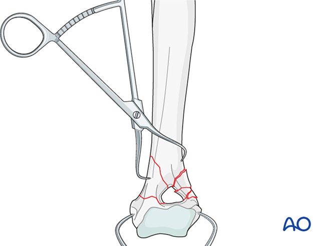 Double buttress plating for Complex extra-articular fractures of the ...