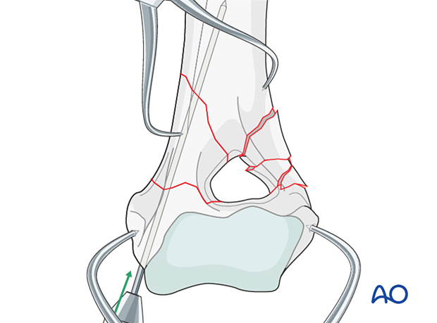 Double buttress plating for Complex extra-articular fractures of the ...
