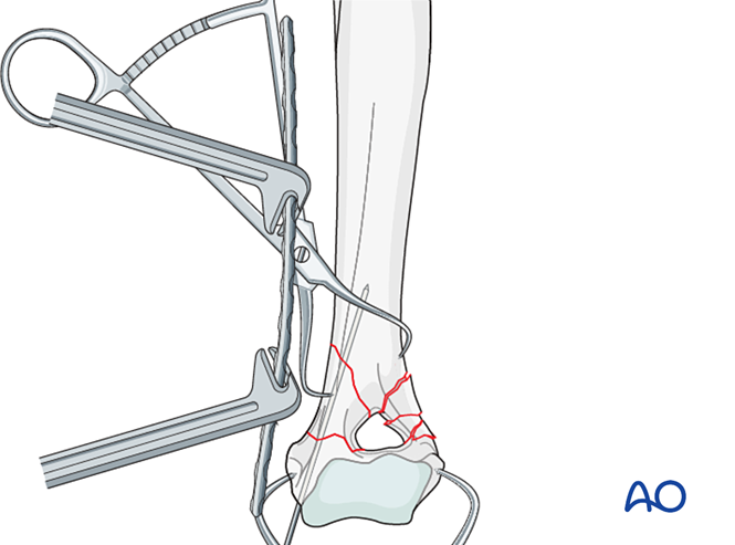 Double buttress plating for Complex extra-articular fractures of the ...