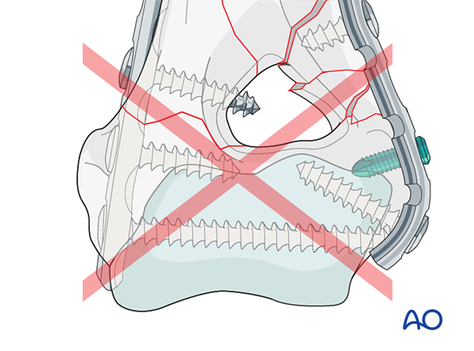 Double buttress plating for Complex extra-articular fractures of the ...