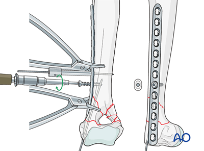Double buttress plating for Complex extra-articular fractures of the ...
