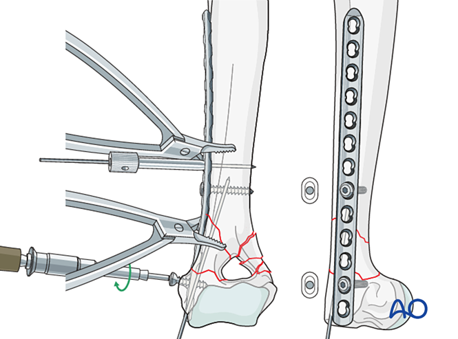 Double buttress plating for Complex extra-articular fractures of the ...