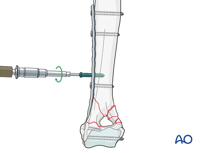 Double buttress plating for Complex extra-articular fractures of the ...