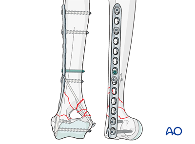 Bridging plate and pin for Complex extra-articular fractures of the dog ...