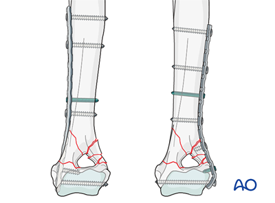 Bridging plate and pin for Complex extra-articular fractures of the ...